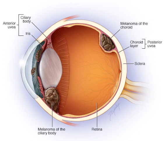 Ocular Tumors | Alliance Retina Consultants